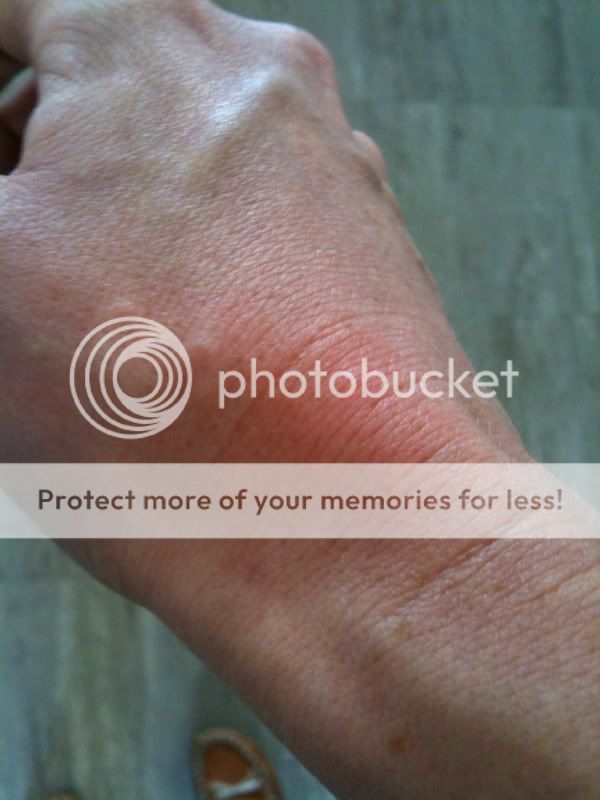 LymeNet Flash: Day 5 Biaxin - Rash Photos - Please look!