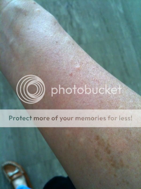 LymeNet Flash: Day 5 Biaxin - Rash Photos - Please look!